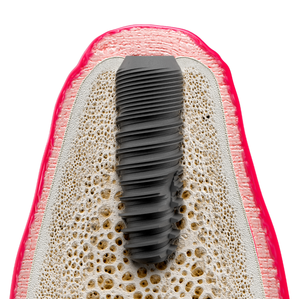 C-tech Implant - Dentali Group